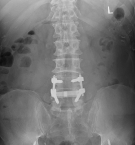 Revolutionizing Spine Surgery: Prone Transpsoas Technique | Orthopaedic ...