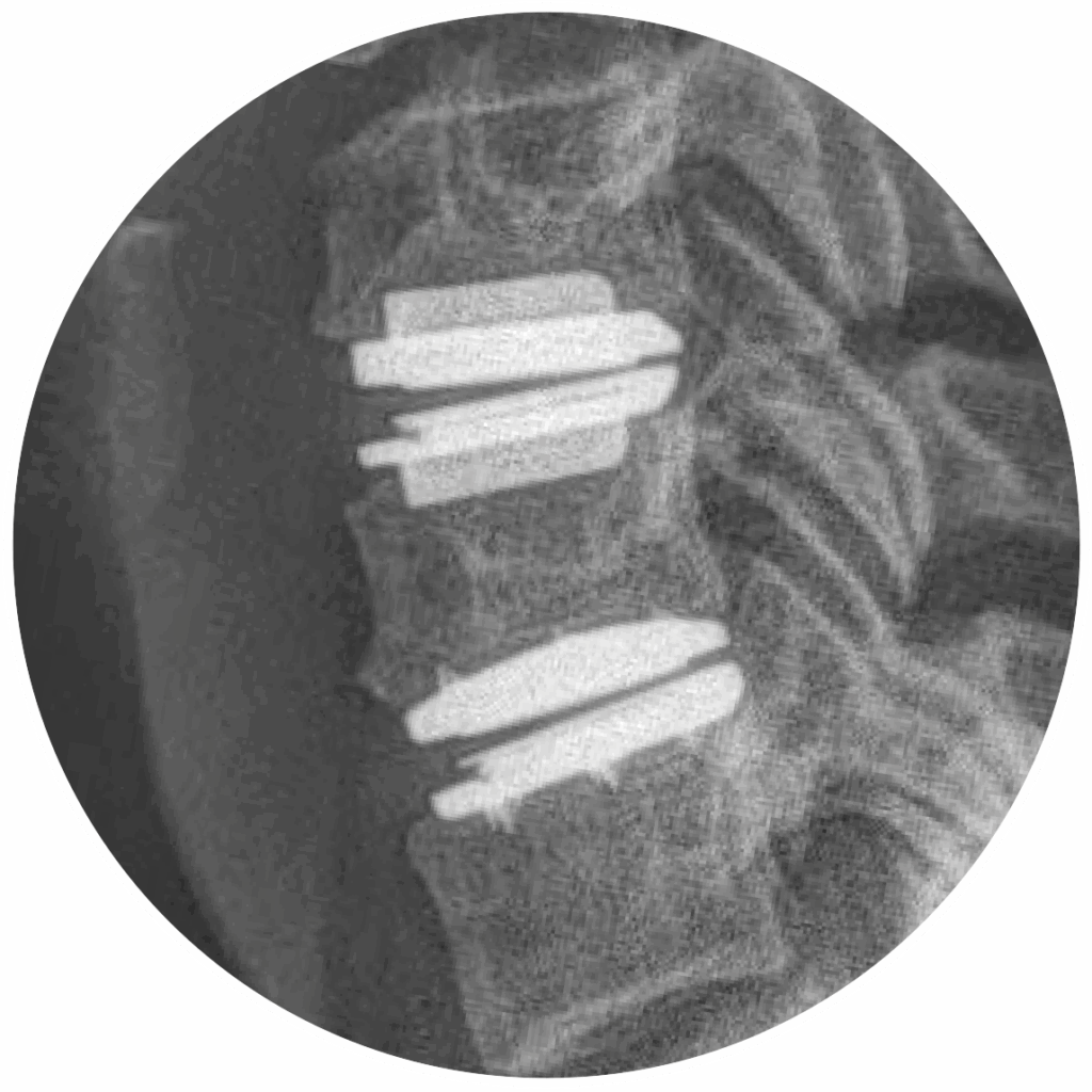 Cervical Disc Replacement Offers Relief for Degenerative Disc Disease ...